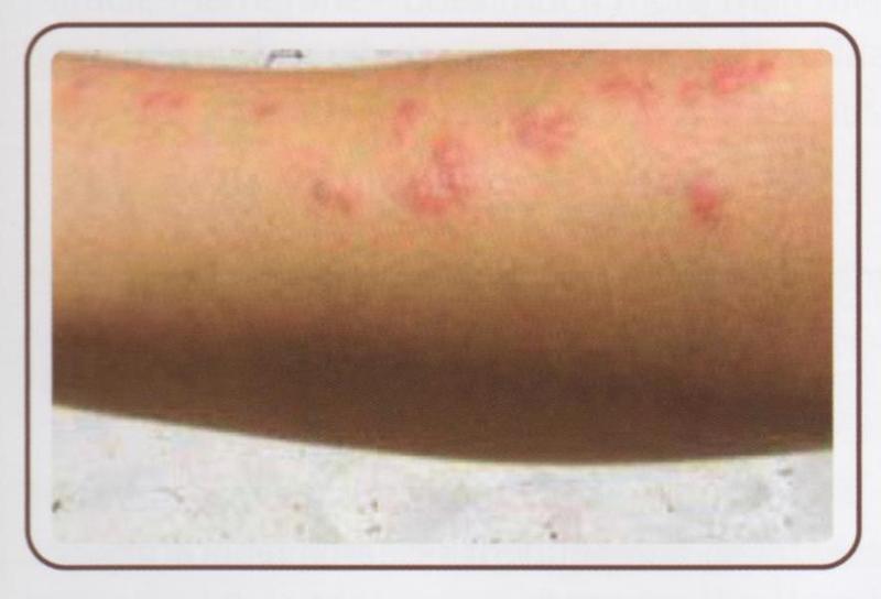 Bugland Pest Management Inc - BED BUGS